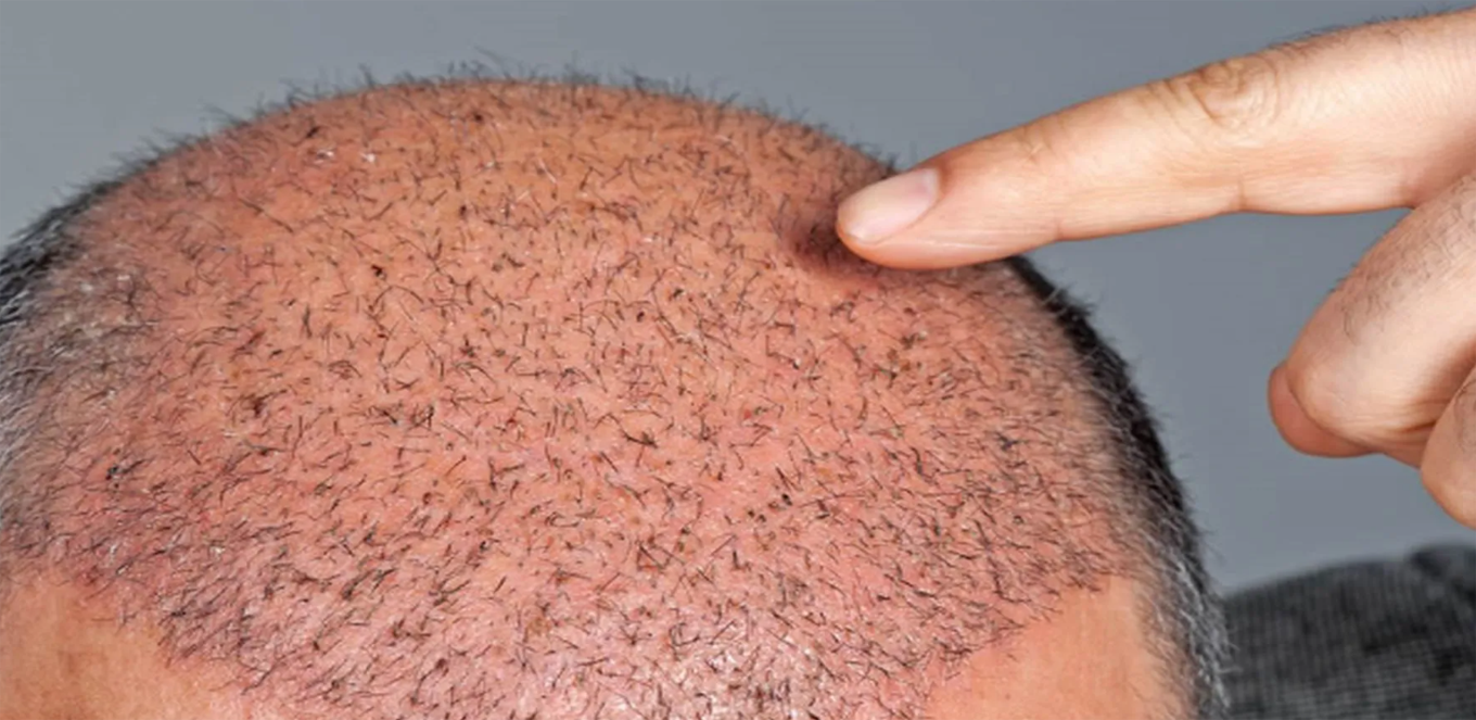 Transplantasi Tanam Rambut